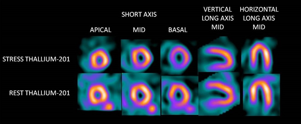 Thallium-201 for Myocardial Perfusion Imaging | Lantheus