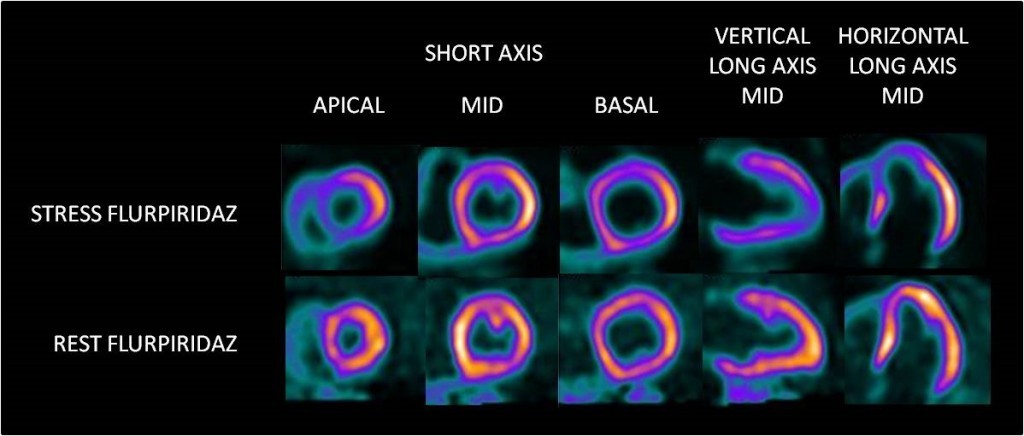 Flurpiridaz F 18 PET Imaging Agent | Lantheus